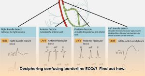 Confused Borderline ECG? Your Patient Guide to Next Steps - Lifestyle ...
